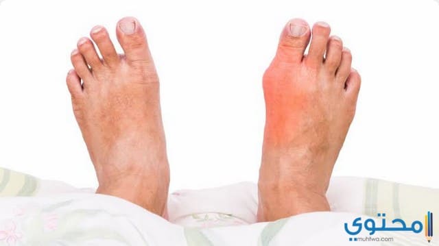 دواء زانسيستوب (Xanthistop) دواعي الاستعمال والاثار الجانبية - موقع محتوى